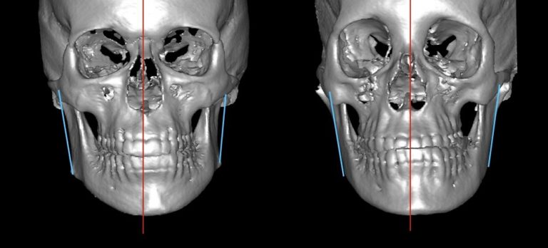 Does facial skeletal asymmetries have the same components in Class I ...